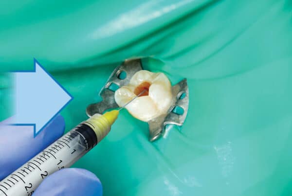 Irrigation Protocol – Vista Apex